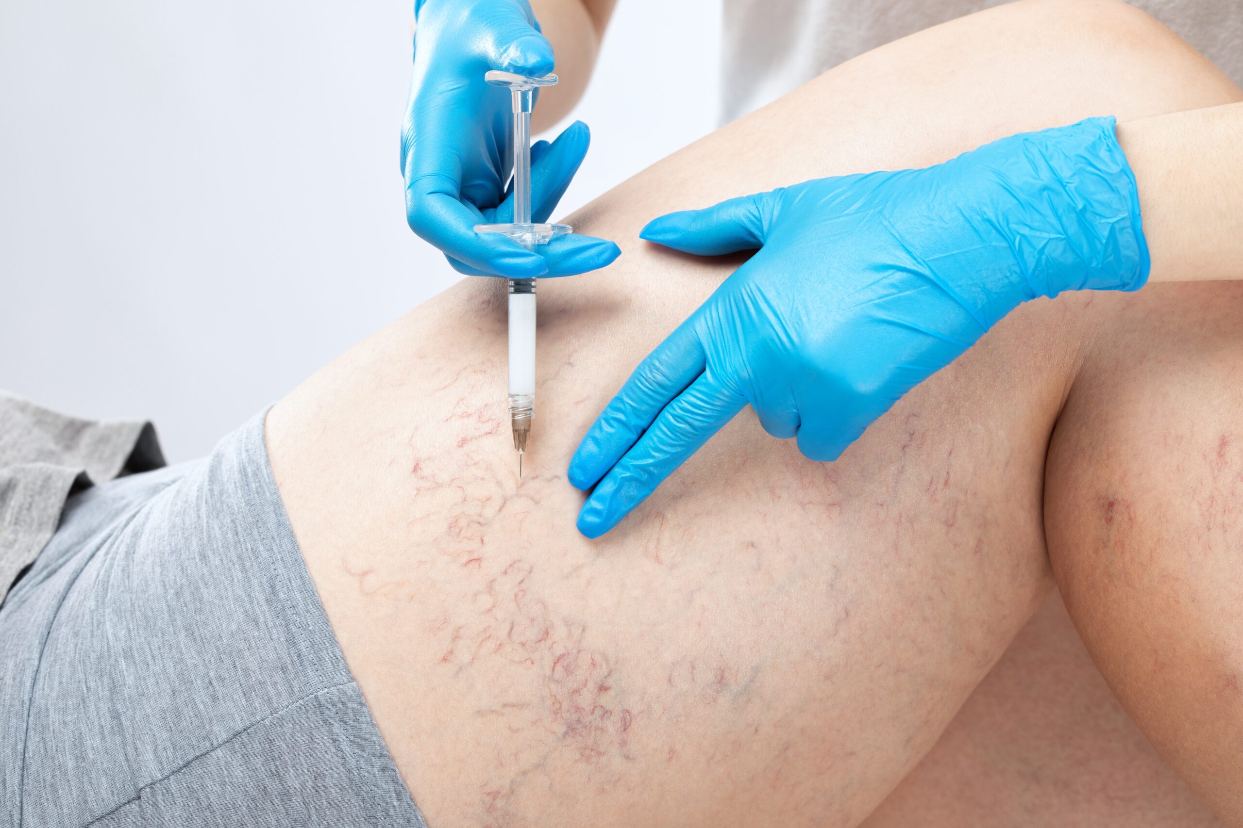 How to Know If Sclerotherapy Is Right for You - North Shore Vein Center